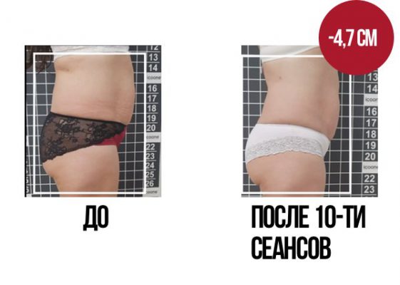 Результаты применения технологии ICOONE LASER | DUSO